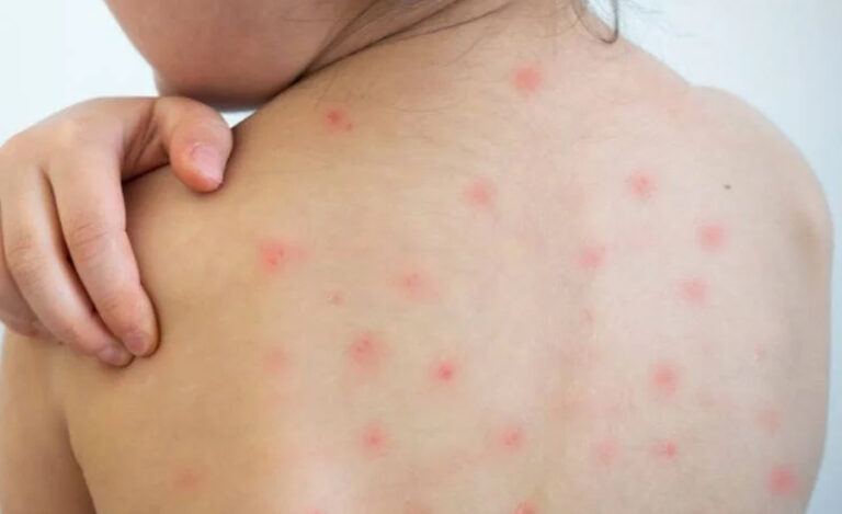 सुर्नयामा ठेउला सङ्क्रमणबाट बालबालिका प्रभावित